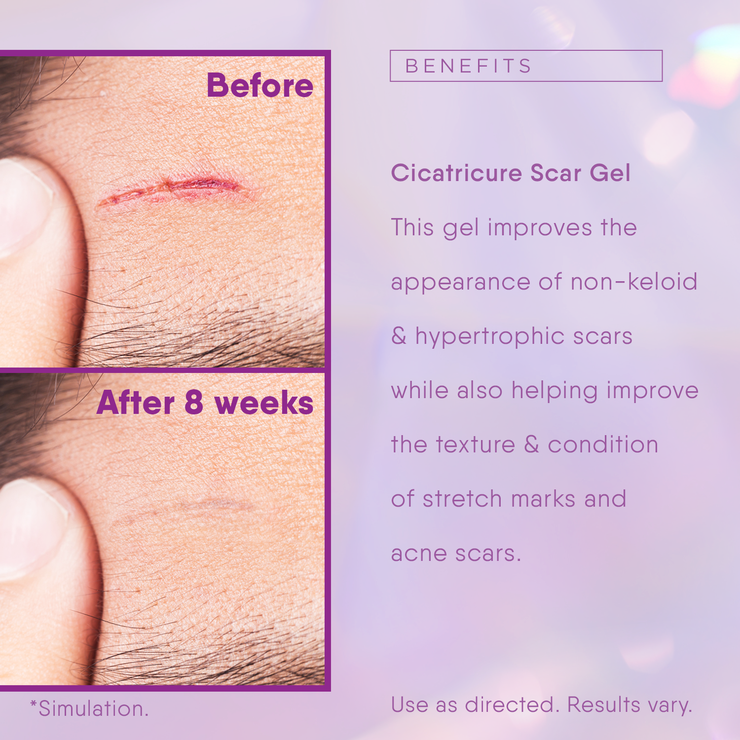 CICATRICURE Face & Body Scar Gel, Reduces the Appearance of Scars from ...